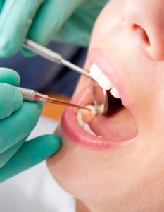 Understanding How Cavities Form - Art of Modern Dentistry