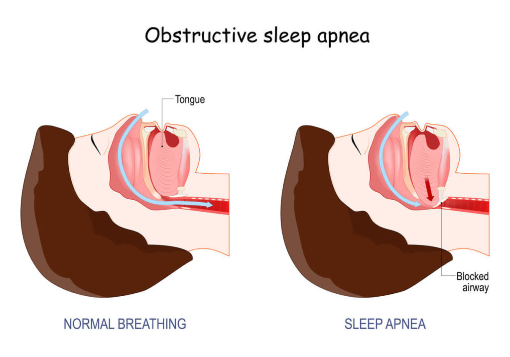 Can Stress Cause Sleep Apnea?
